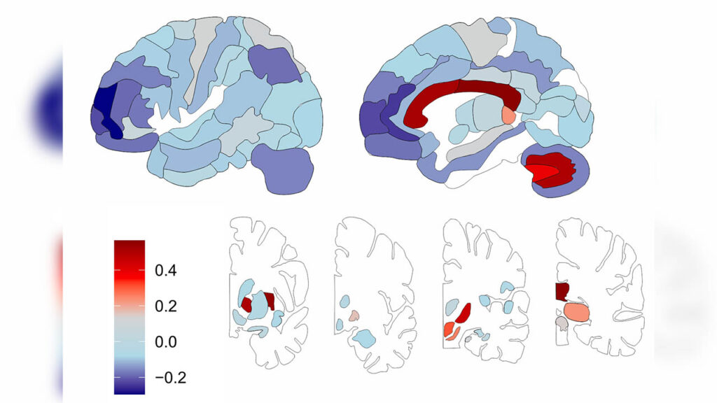 First map of human brain lipids - Commonwealth Union
